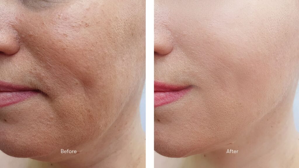 Diamond Glow Facial Riverside in Riverside, CA - Skin Clinic Med Spa